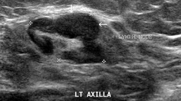Axillary Ultrasound Video Image - Breast Cancer School for Patients