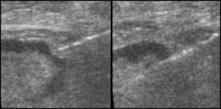 Axillary Ultrasound: Breast Cancer School for Patients